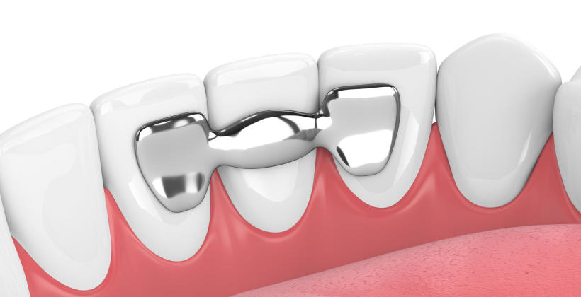 Kiedy stosuje się w stomatologii kompozytowy most adhezyjny?